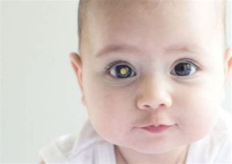 Retinoblastoma