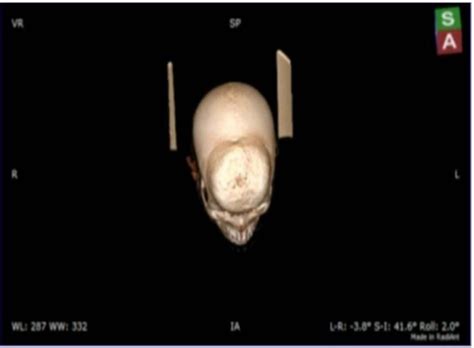 Superior View Of The Ct Scan Of The Head With 3d Reconstruction Showing Download Scientific