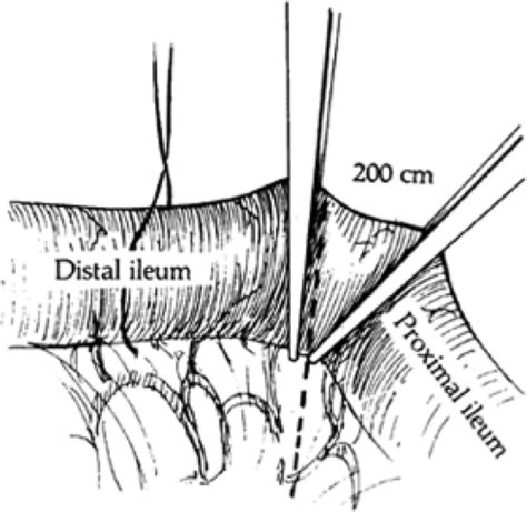 Metabolic Surgery And Intestinal Bypass For Hypercholesterolemia Basicmedical Key