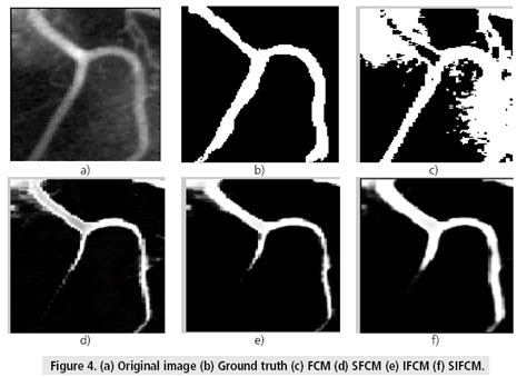 Spatial Intuitionistic Fuzzy Set Based Image Segmentation