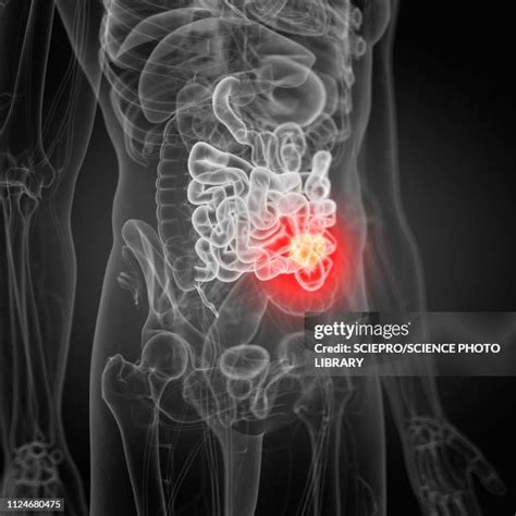 Intestine Tumor Photos And Premium High Res Pictures Getty Images