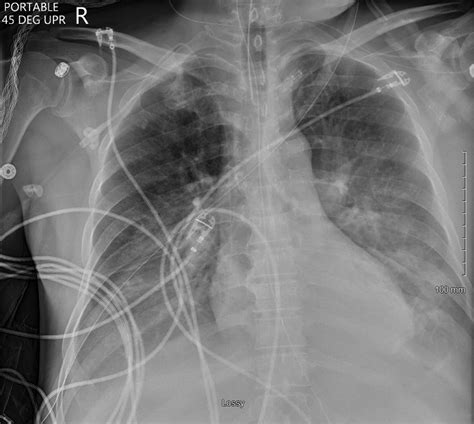 Revisiting Pleural Effusion Renalplatohealthai