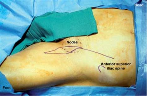 Radical Groin Dissection Basicmedical Key