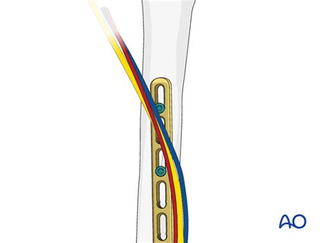 Orif Plate Fixation Distal 1 3 For Multifragmentary Fracture Intact Segment