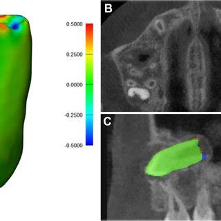 Comparison Of Automated And Semi Automated Maxillary Impacted Canine