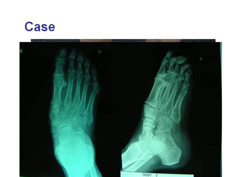 Lisfranc