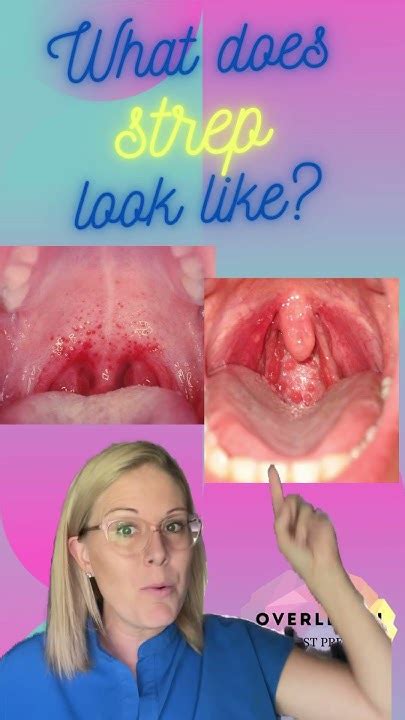 What Does Strep Look Like Exampreparation Nursing Nclexreview Testprep Streptococcus