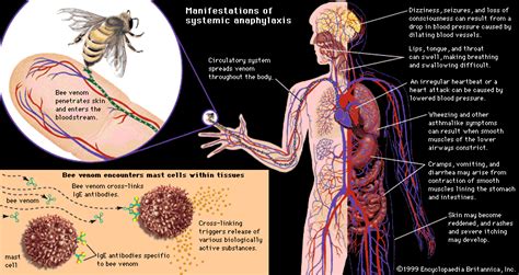 Anaphylaxis Physiology Britannica
