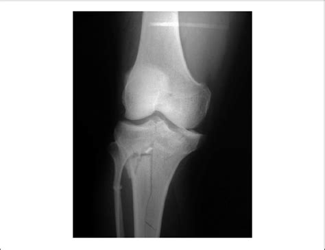 Schatzker Type V Fracture Download Scientific Diagram