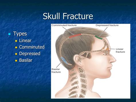 Open Vs Closed Fracture