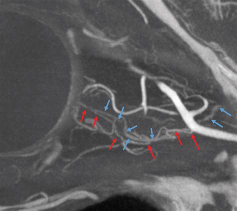 Ophthalmic Artery Occlusion