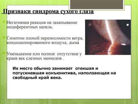 Синдром сухого глаза - презентация онлайн