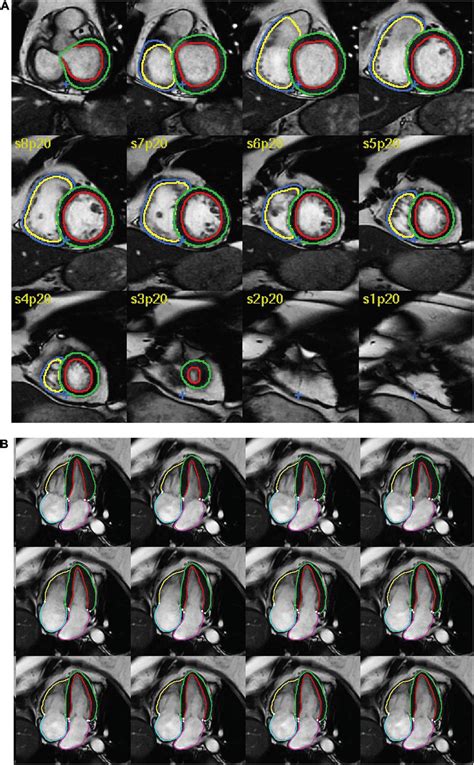 Examples Of Ai Cardiac Mri Segmentation Examples Of Automatic A Download Scientific Diagram