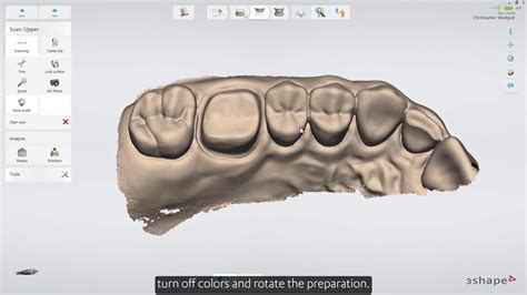 3shape Trios Crown Workflow Youtube 3shape Trios Crown Workflow Youtube