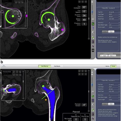 Preoperative Planning For A Acetabular And B Femoral Components On Download Scientific