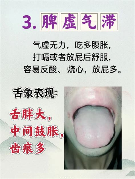 脾虚常见6大舌象脾气虚脾胃虚寒脾虚气滞你是哪一种 哔哩哔哩