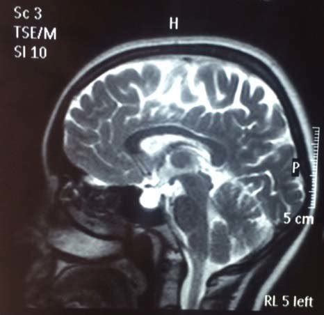 Sagittal T Weighted Mri Image Before The Shunt Procedure Shows