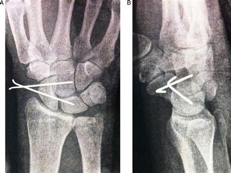 Scaphoid Dislocation Internet Scientific Publications