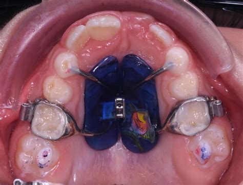 Съемные ортодонтические аппараты для детей Цены преимущества и отзывы