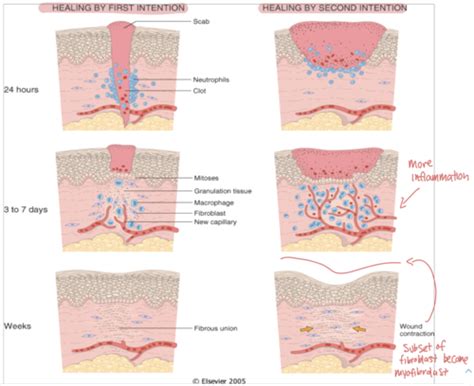 Lecture 15 Tissue Repair And Pathologic Calcification Flashcards Quizlet