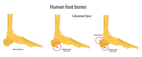 Calcaneal Spur」の写真素材 871件の無料イラスト画像 Adobe Stock