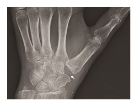 Postoperative Radiographic Measurements A Proximal Migration Of The