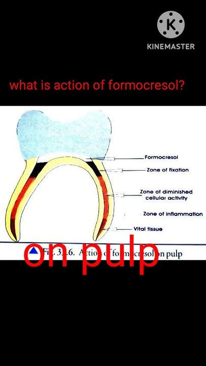 Use Of Formocresol In Dentistry Youtube