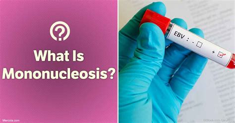 What Is Mononucleosis