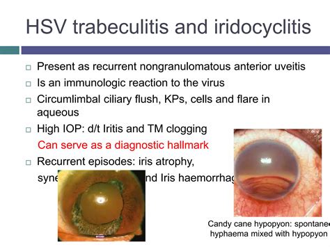 Viral Keratitis Diagnosis And Management Pptx