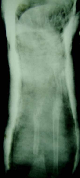 A Patient With Nf1 Presenting With Radial Fractures Note Also Download Scientific Diagram