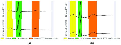 A Sample Of One Beat Ecg Signal Delineation Results For A Download Scientific Diagram