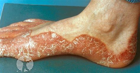 Acquired Palmoplantar Keratoderma Image