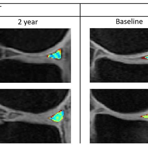 Outerbridge Classification Download Table Outerbridge Classification Download Table