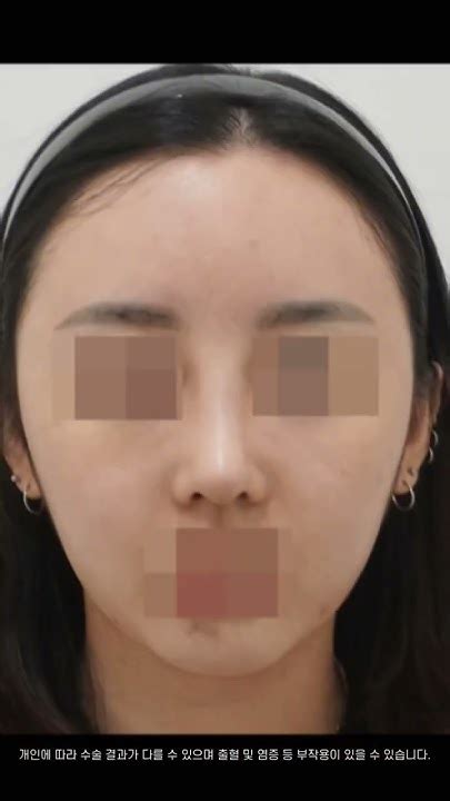 밋밋한 코 늘어진 이중턱 은 코수술 과 이중턱근육묶기 로 해결 더도어성형외과 코성형 이중턱수술 전후사진 Shorts Youtube