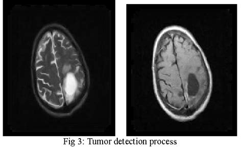 Figure 2 From An Adaptive Mri Tumor Detection Using Neural Network Based Adaboost Algorithm