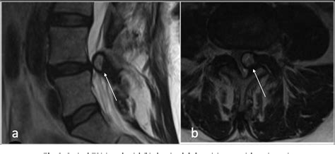 Figure 3 From Anatomy And Pathology Of Facet Joint Semantic Scholar