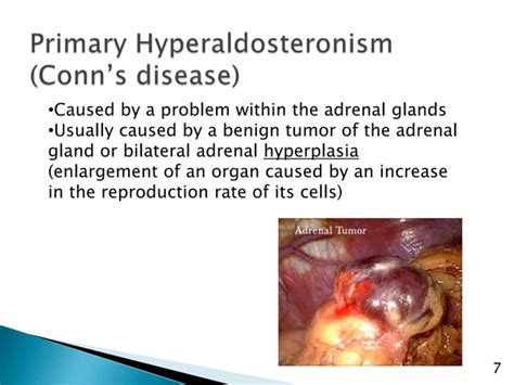 Hyperaldosteronism Pptx