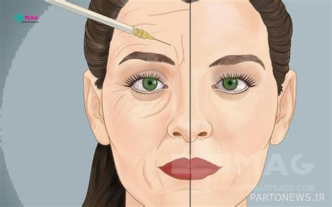 What Is Botox Comprehensive Guide And All Tips Before And After Botox