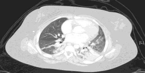 Figure2 Ct Chest Showing Atelectasis In The Left Lower Lobe Case 3