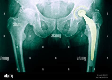 Hip Prosthesis X Ray Stock Photo Alamy