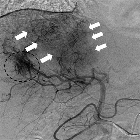 Pdf Diffuse Infiltrative Hepatocellular Carcinoma With Portal Vein