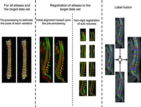 Registration For Accurate Segmentation Of Thoracic And Lumbar Vertebrae In CT Data Radiology Key