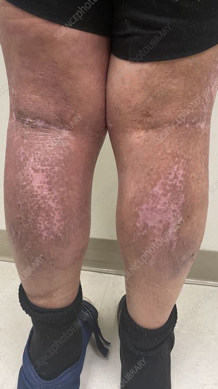 Psoriasis Stock Image C060 4160 Science Photo Library