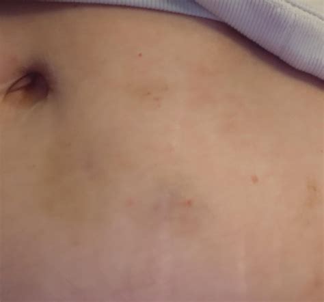 Bruising At Injection Site Am I Doing Something Wrong R Peptides