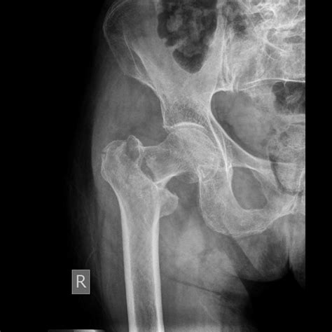 Femoral Neck Hip Fracture