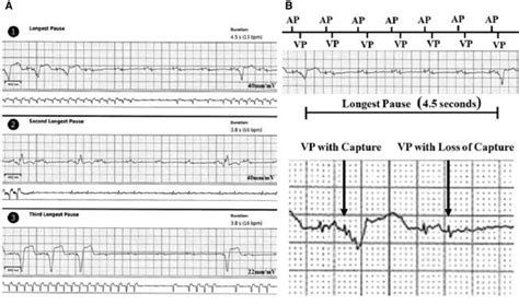 Zio ® Xt Patch Recordings Of Pauses Demonstrating Ventricular Loss Of Download Scientific