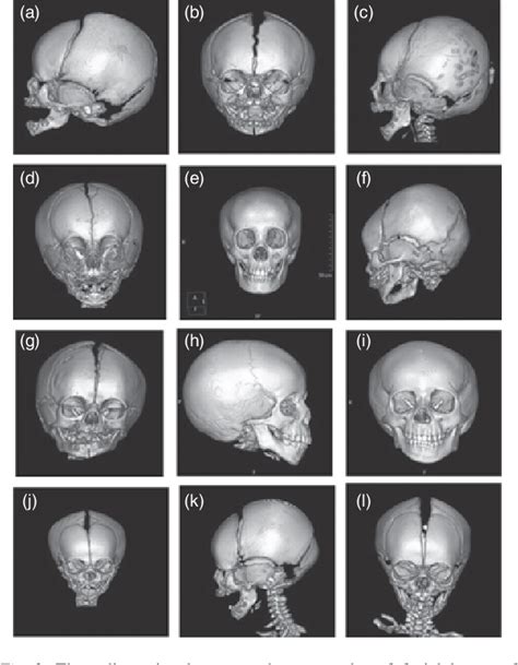 Treacle Protein Semantic Scholar