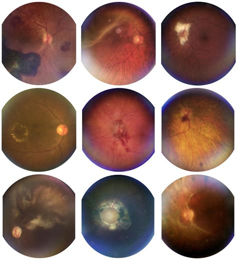 Smartphone Imaging 2 Ucsf Department Of Ophthalmology