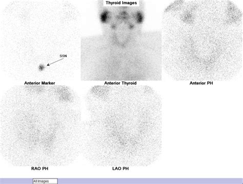 Subacute Thyroiditis