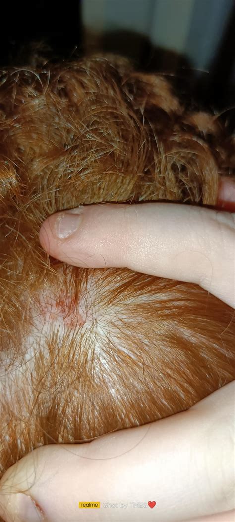 Marked Nsfw Due To Raw Looking Lesion On Scalp Is This Part Of Cfs Me I Dont Know Whats